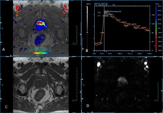 Extracapsular Extension - Sperling Prostate Center