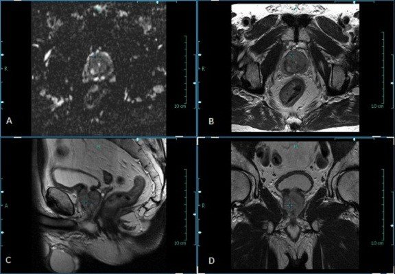 Extracapsular Extension - Sperling Prostate Center