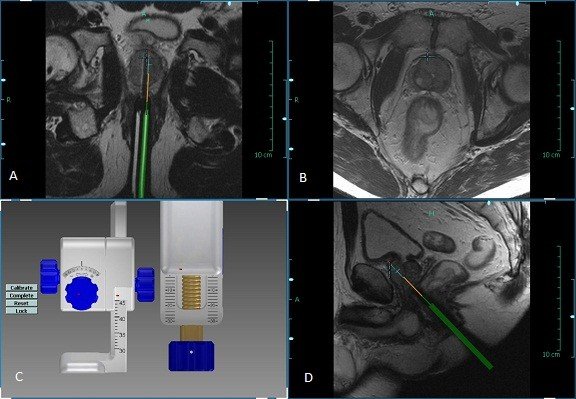 Extracapsular Extension - Sperling Prostate Center