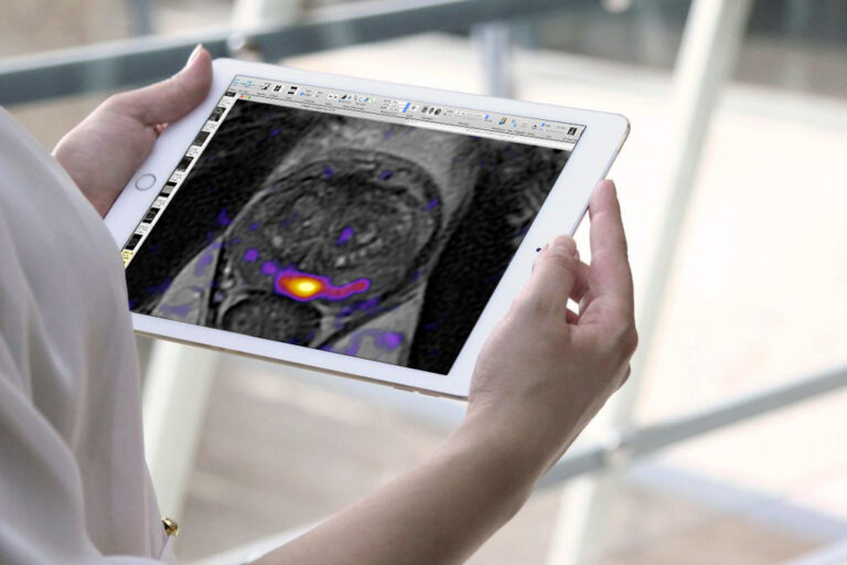 Understanding the PI-RADS Score and What it Means for You - Sperling ...