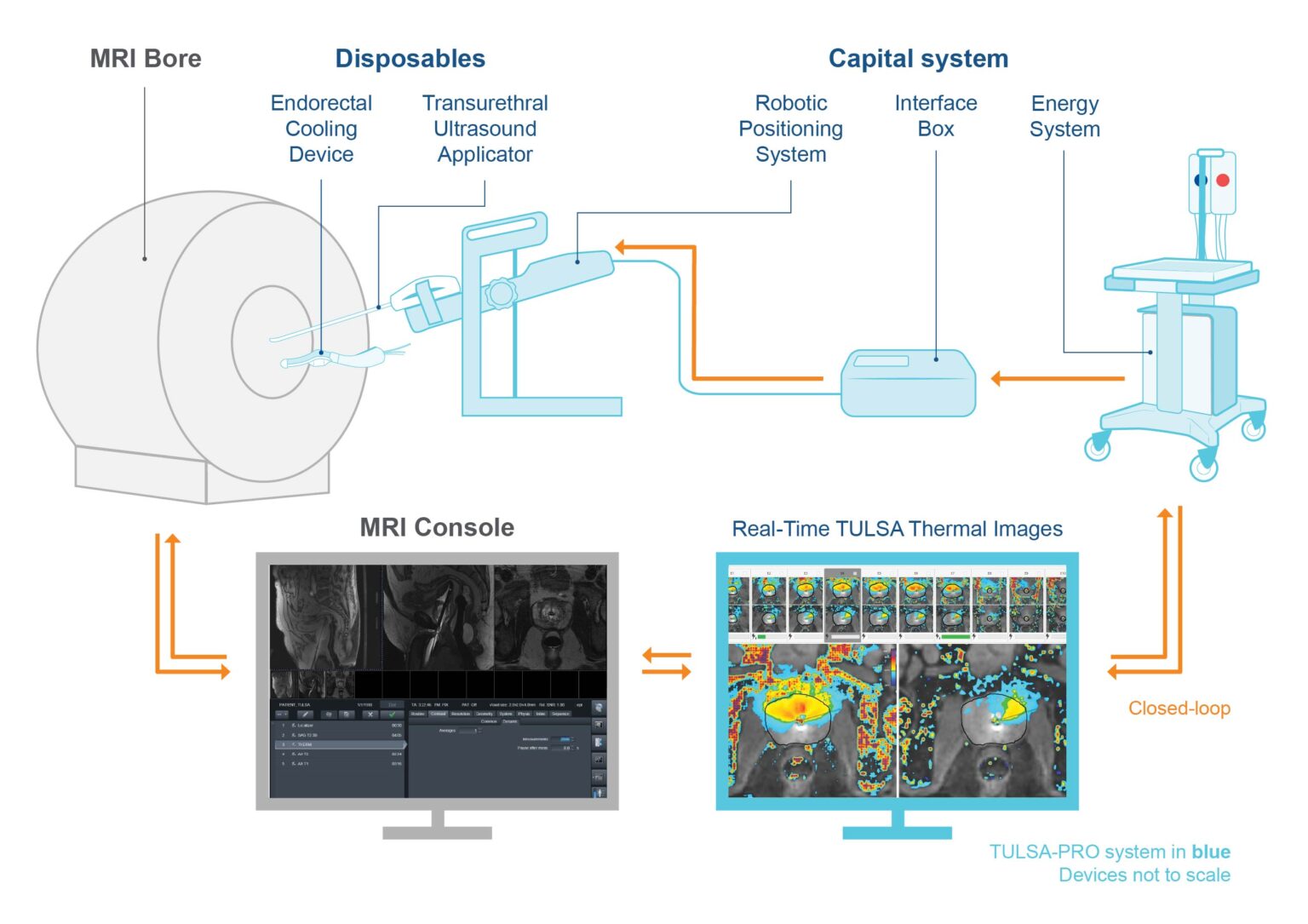 TULSA-PRO Ablation for Prostate Cancer - Sperling Prostate Center