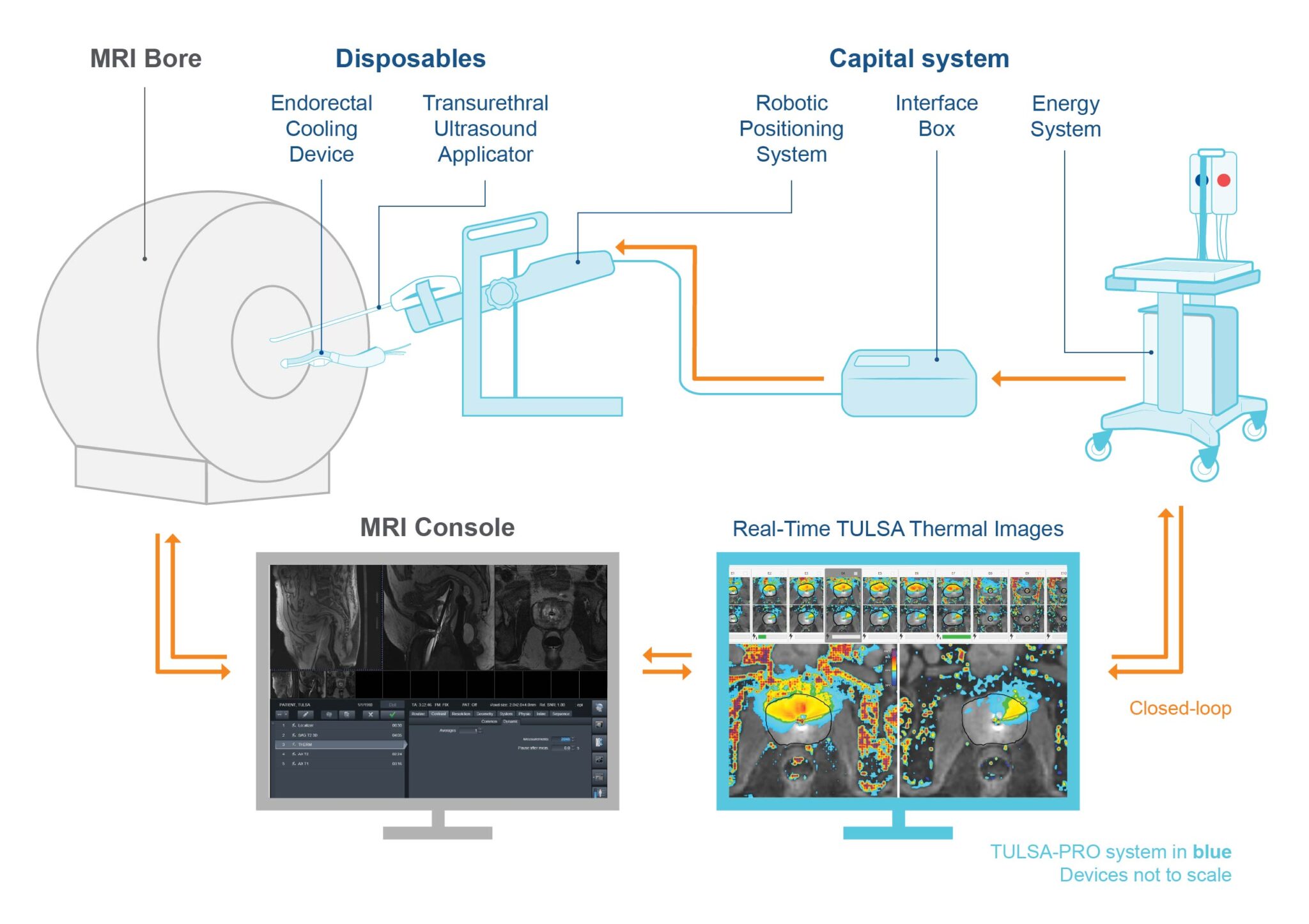 TULSA-PRO Ablation for Prostate Cancer - Sperling Prostate Center