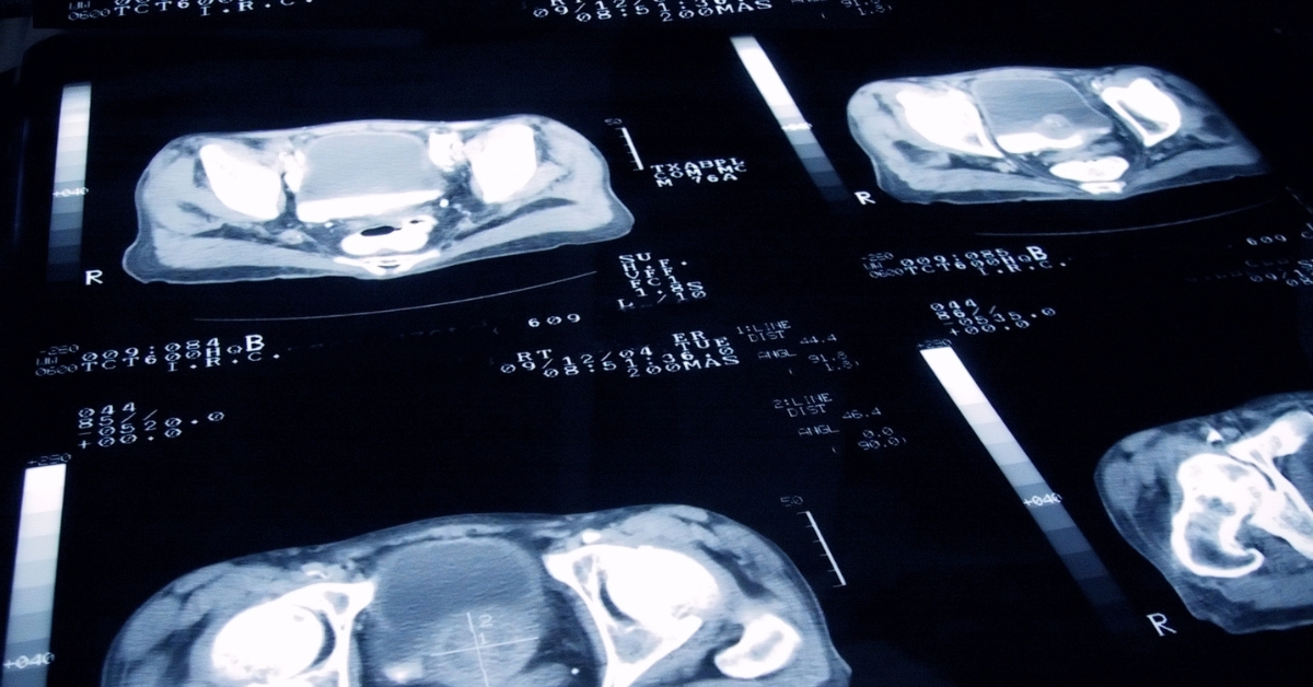 The Promise of MRI Guided Ablation: TULSA and MRgFUS - Sperling ...